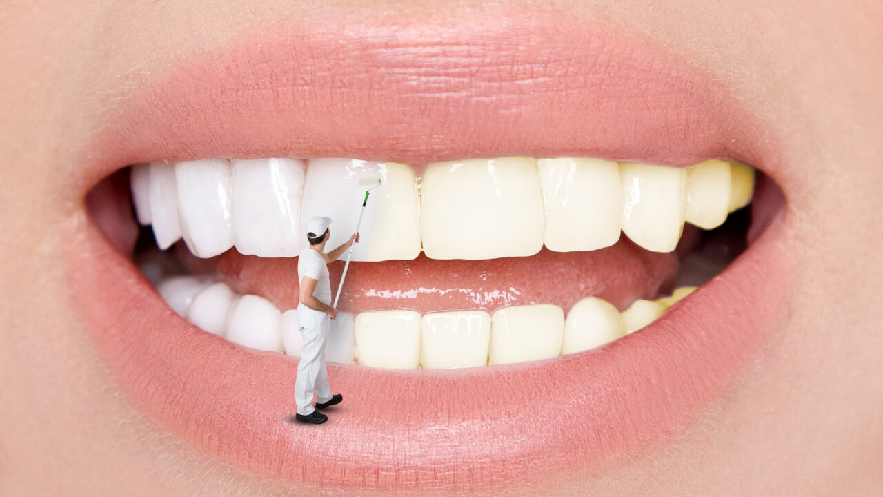 Choosing Between Dental Veneers and Teeth Whitening