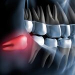 Top Signs You Need Wisdom Teeth Removal Before It Causes Major Dental ...